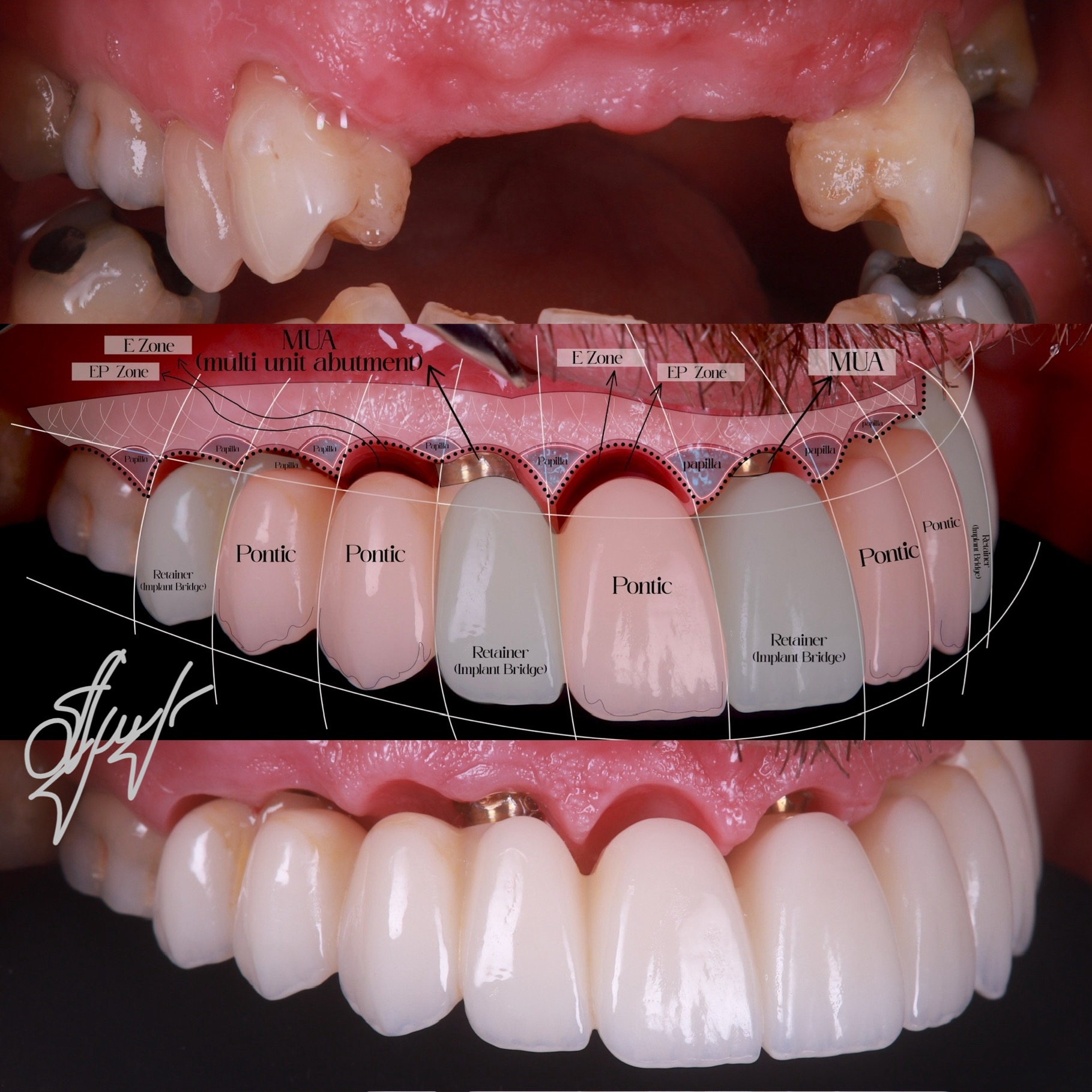 FP1 Hybrid Rehabilitation with Digital Workflow and Live Surgery ...